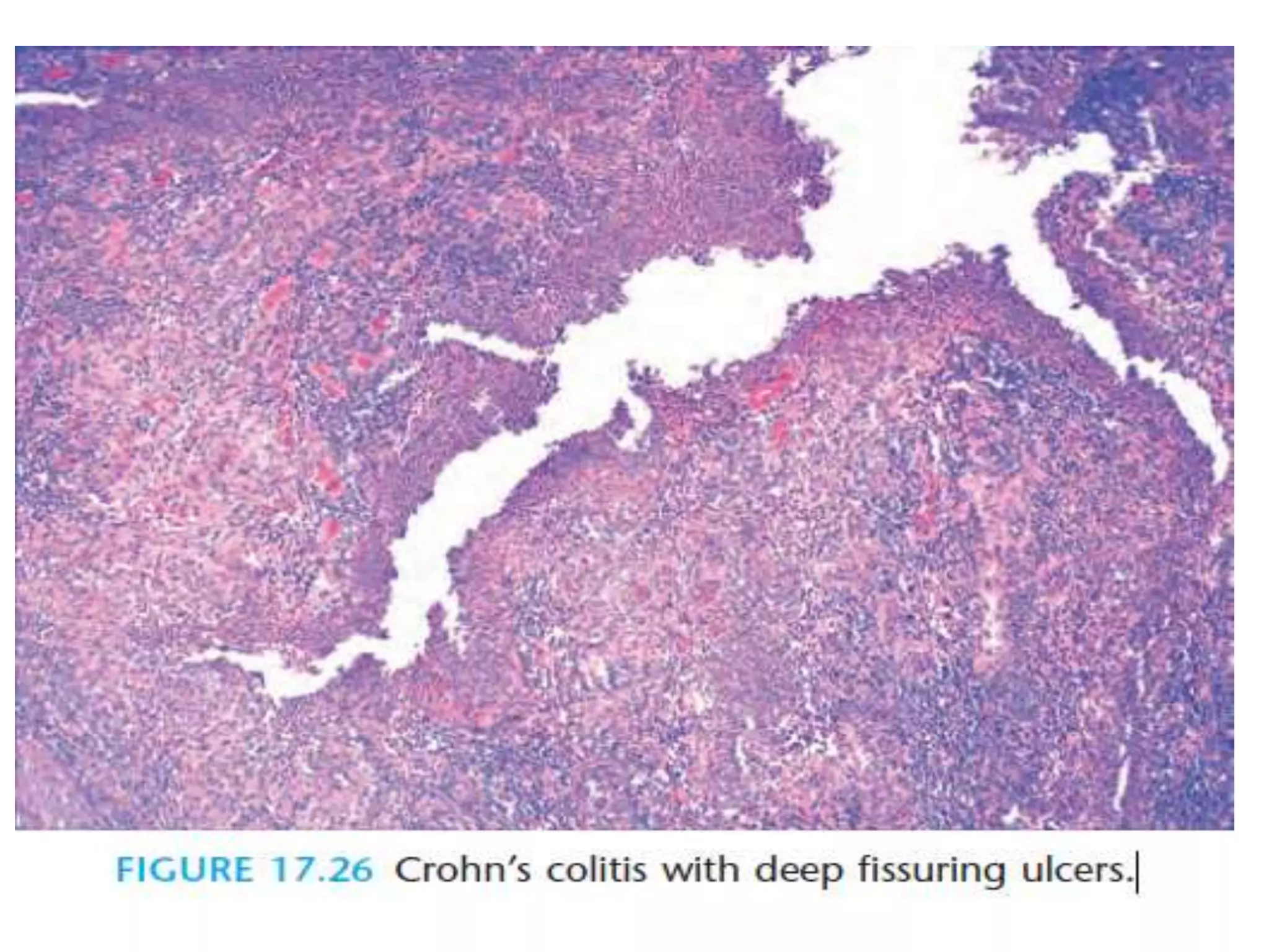 Histology of ibd | PPTX