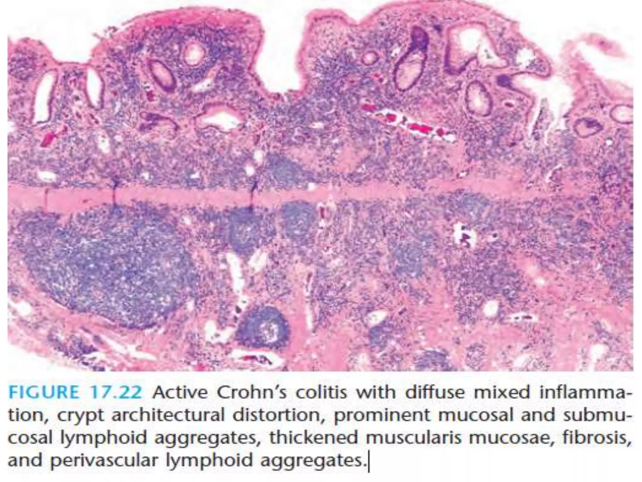 Histology of ibd | PPTX