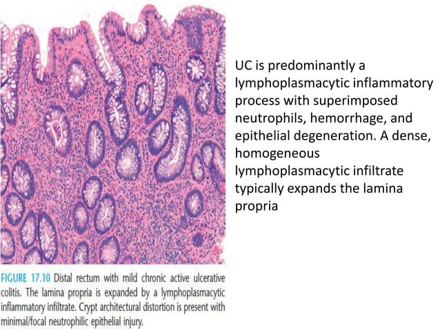 Histology of ibd | PPTX | Digestive Disorders | Diseases and Conditions