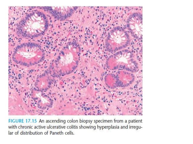 Histology of ibd | PPTX | Digestive Disorders | Diseases and Conditions