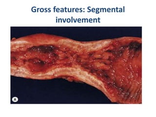 Histology of ibd | PPTX