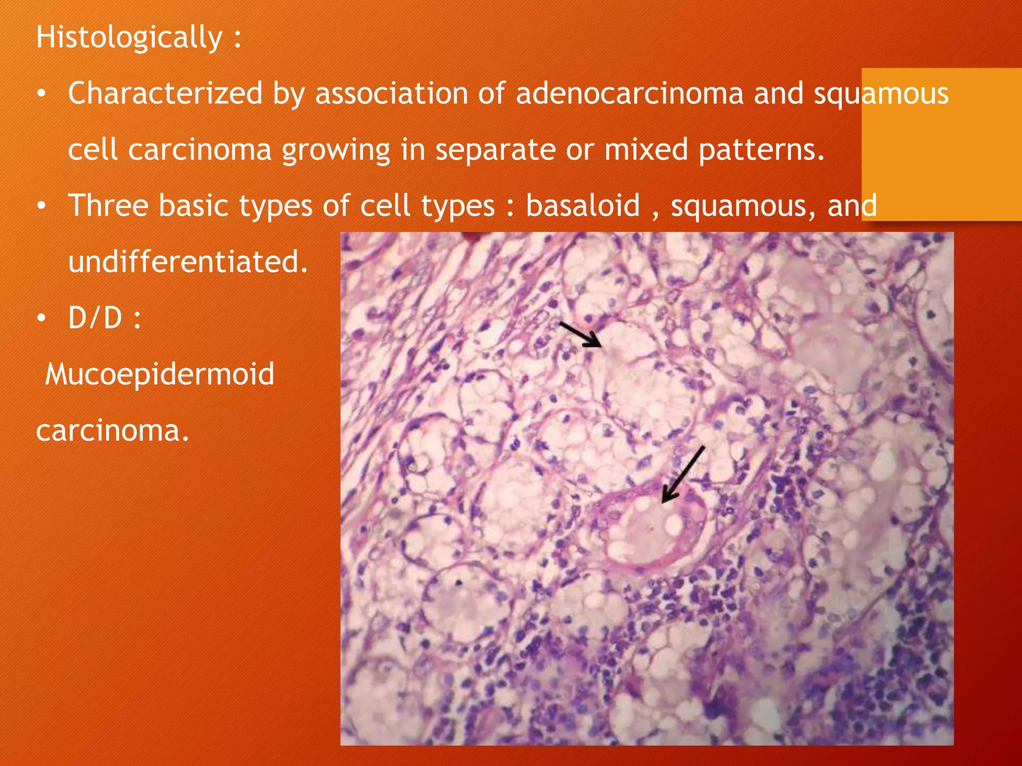 Histology of Oral Cancer | PPTX