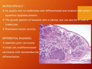 Histology of Oral Cancer | PPTX