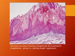Verrucous Carcinoma Histology