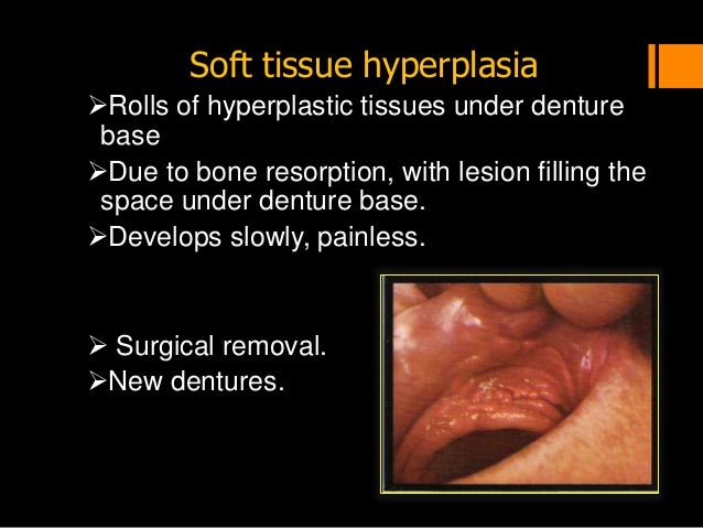 Hyperplastic Tissue