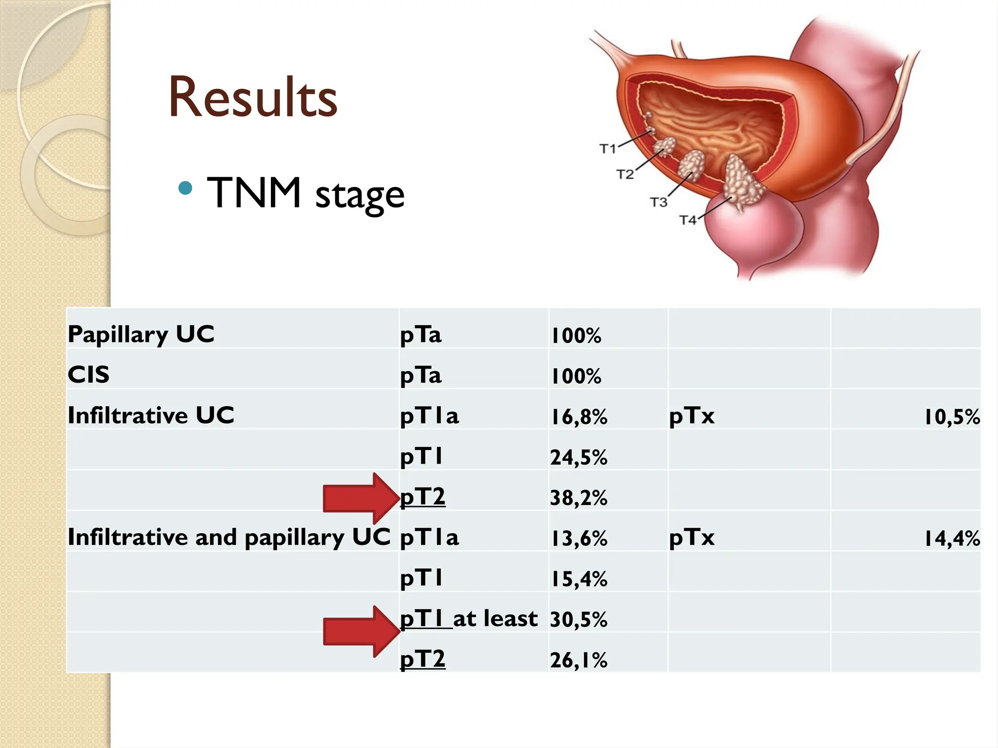 HISTOPATHOLOGICAL DIAGNOSIS OF BLADDER UROTHELIAL CARCINOMA ON ...