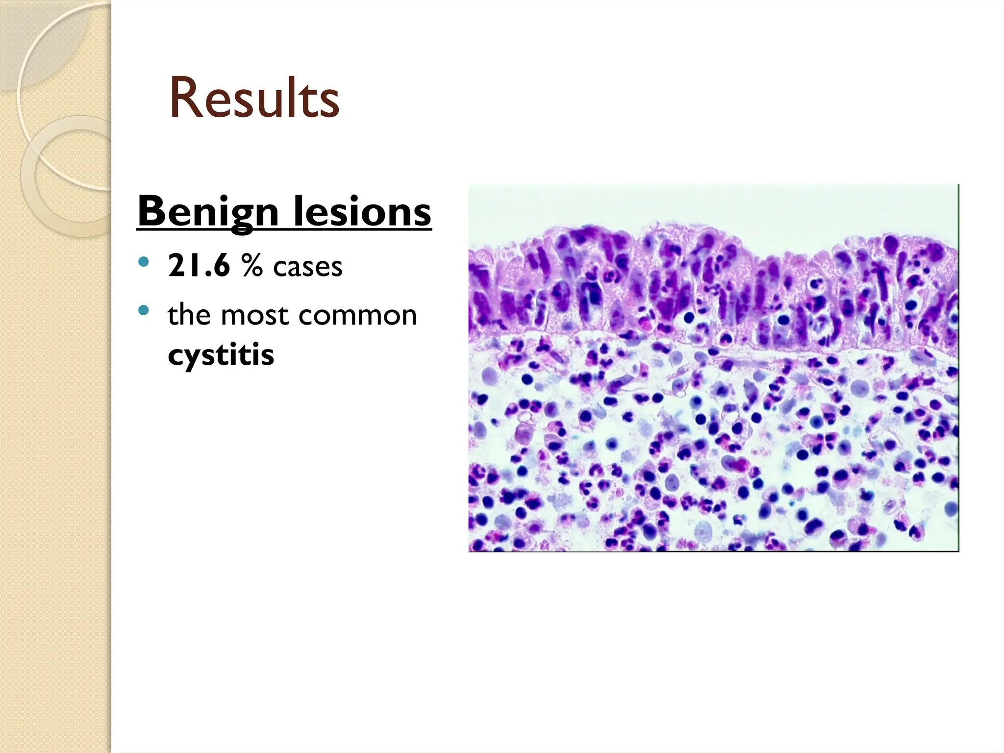 HISTOPATHOLOGICAL DIAGNOSIS OF BLADDER UROTHELIAL CARCINOMA ON ...