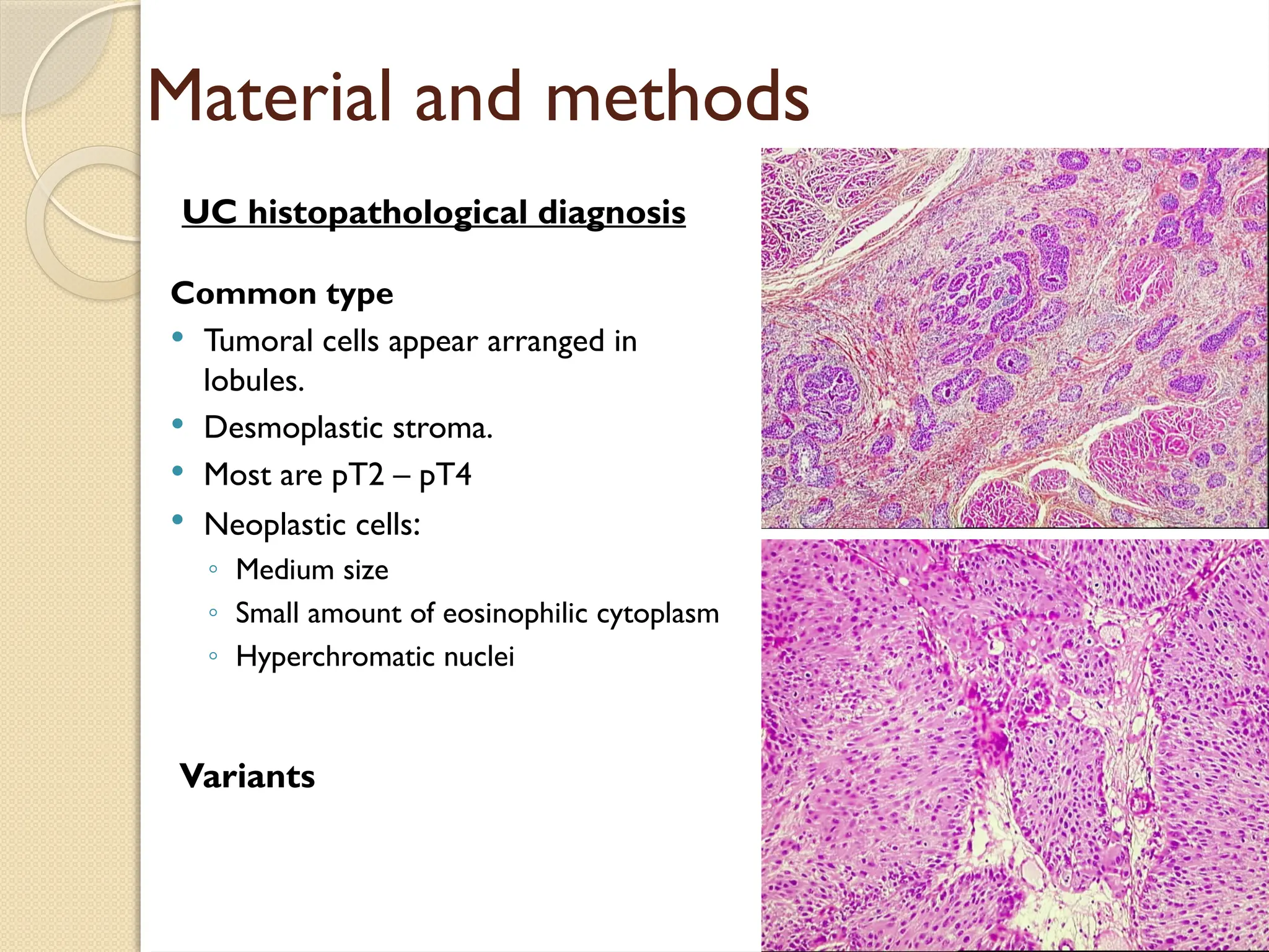HISTOPATHOLOGICAL DIAGNOSIS OF BLADDER UROTHELIAL CARCINOMA ON ...