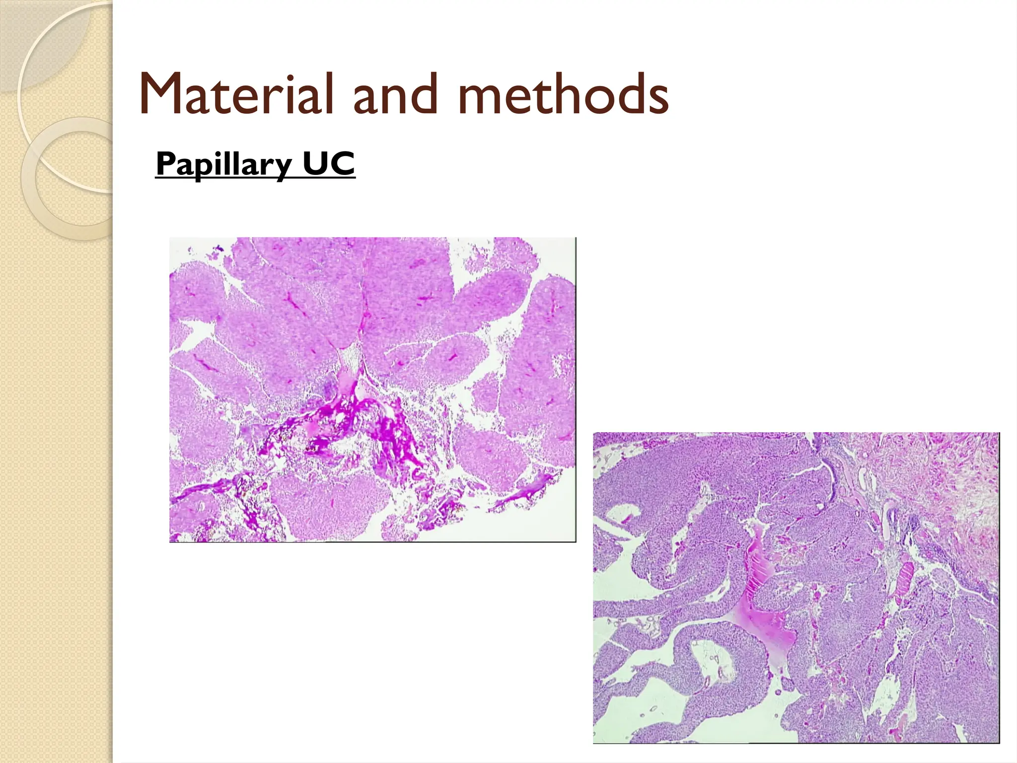 HISTOPATHOLOGICAL DIAGNOSIS OF BLADDER UROTHELIAL CARCINOMA ON ...