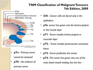HISTOPATHOLOGICAL DIAGNOSIS OF BLADDER UROTHELIAL CARCINOMA ON ...
