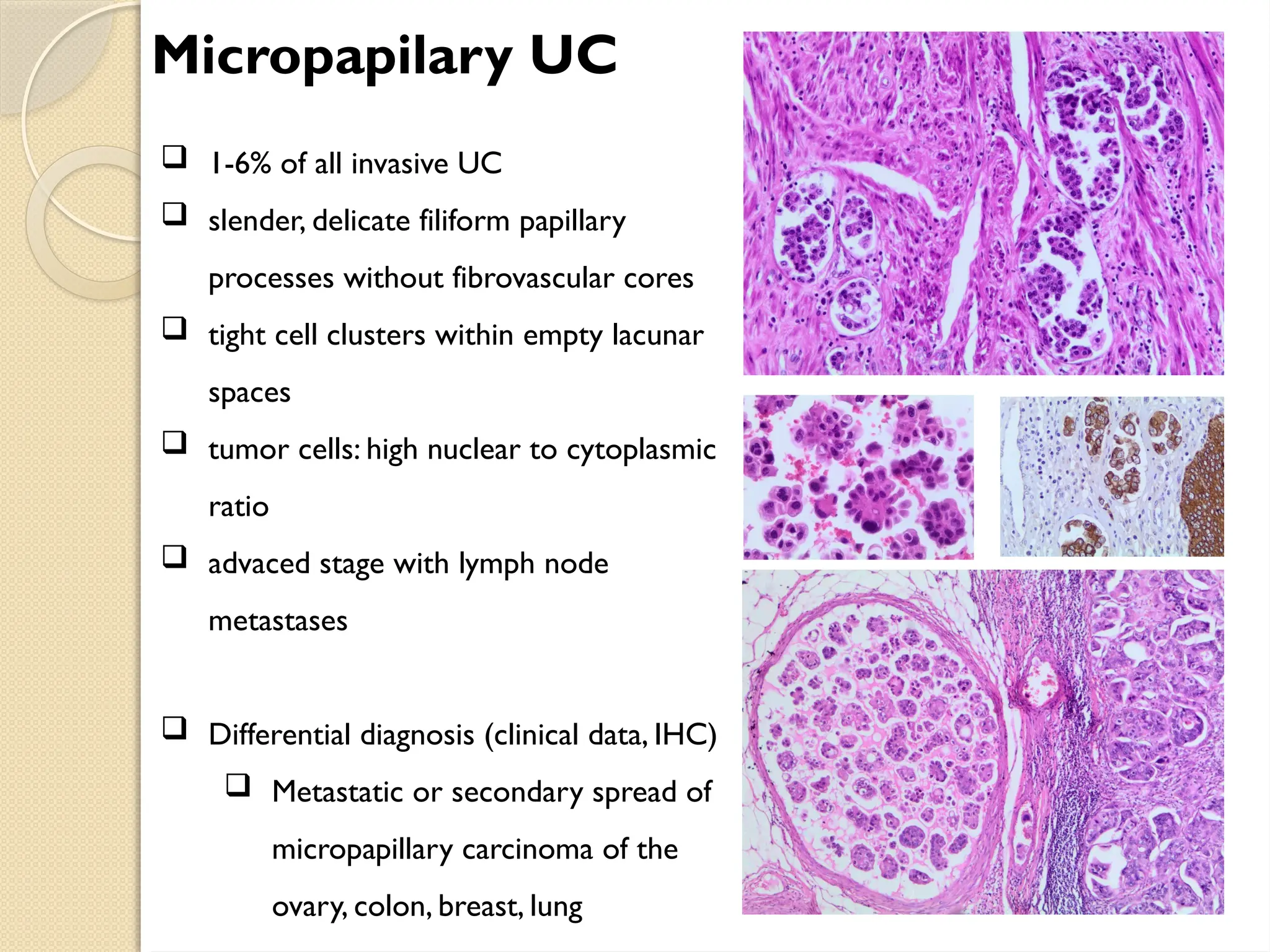 HISTOPATHOLOGICAL DIAGNOSIS OF UROTHELIAL CARCINOMA VARIANTS ON ...