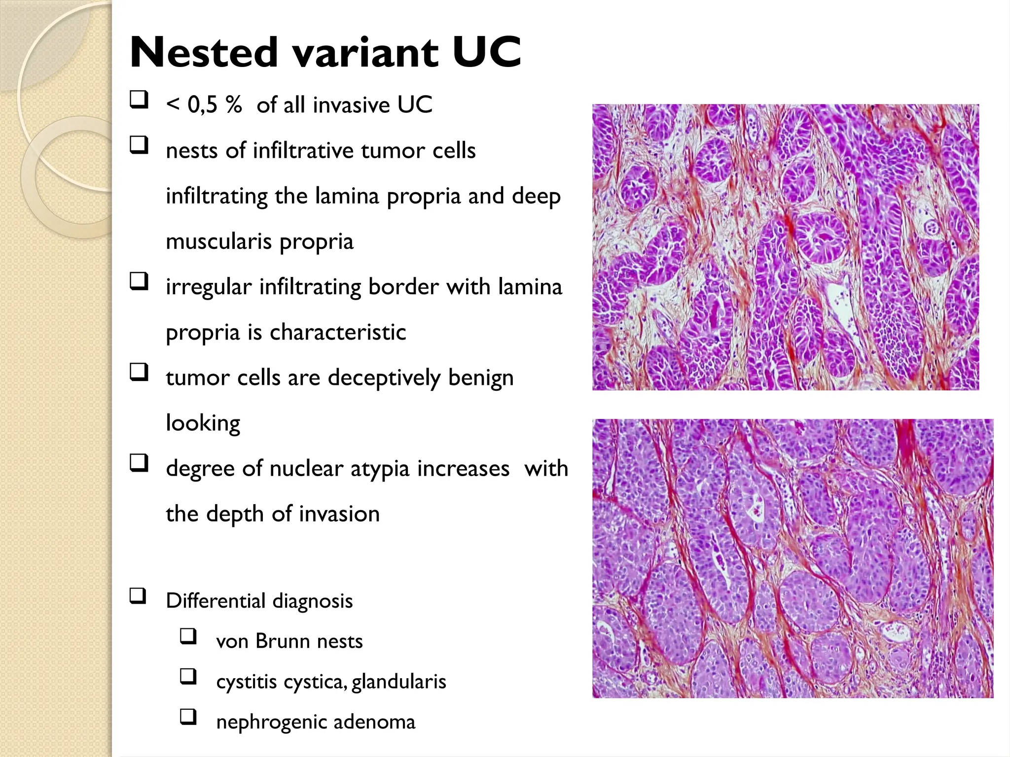 HISTOPATHOLOGICAL DIAGNOSIS OF UROTHELIAL CARCINOMA VARIANTS ON ...