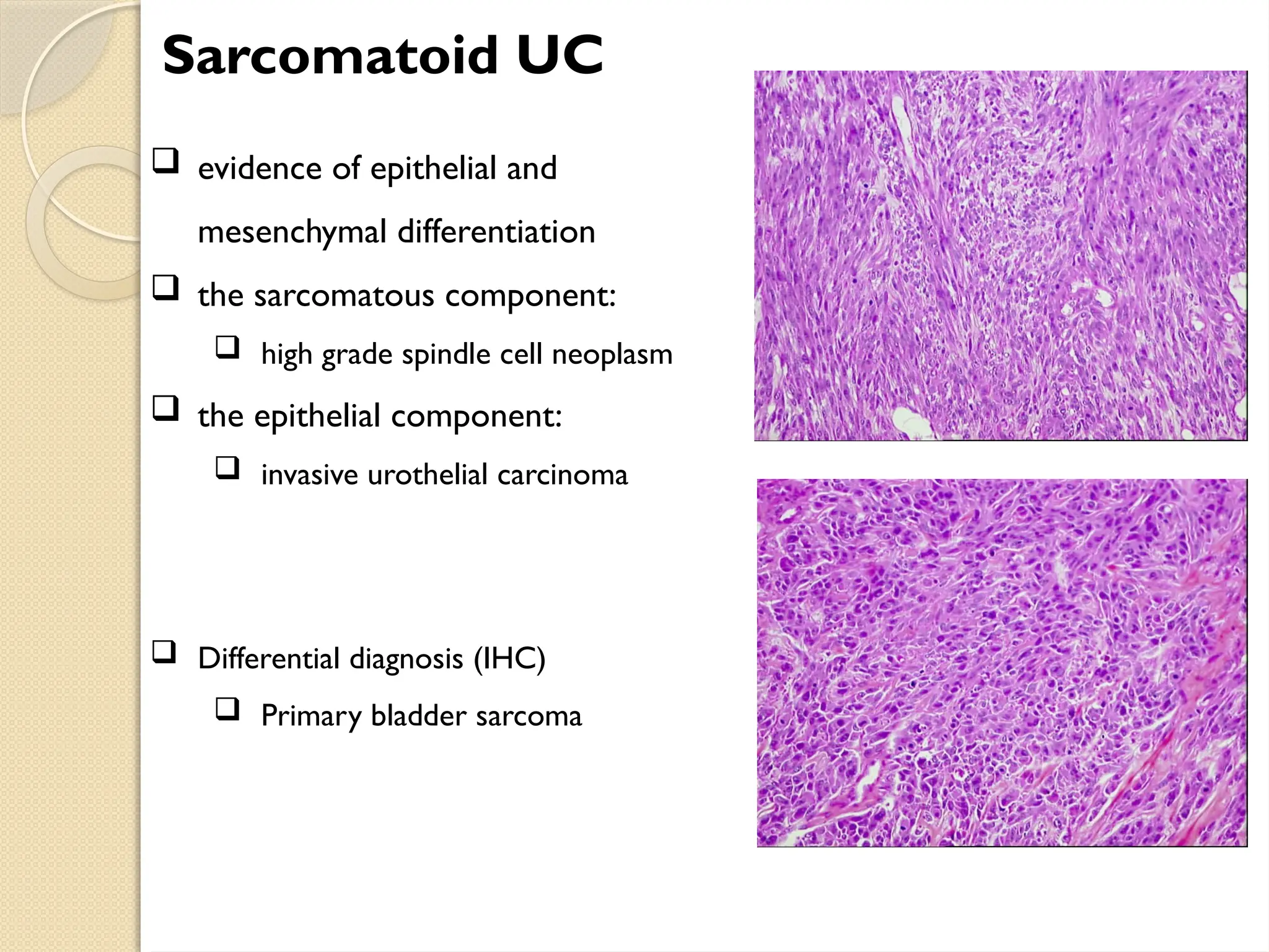 HISTOPATHOLOGICAL DIAGNOSIS OF UROTHELIAL CARCINOMA VARIANTS ON ...