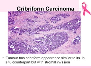 Histopathological dignosis of carcinoma of breast | PPT