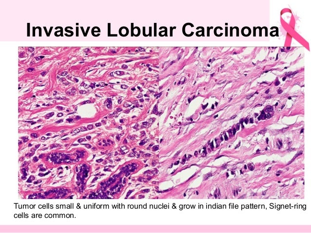 Histopathological dignosis of carcinoma of breast