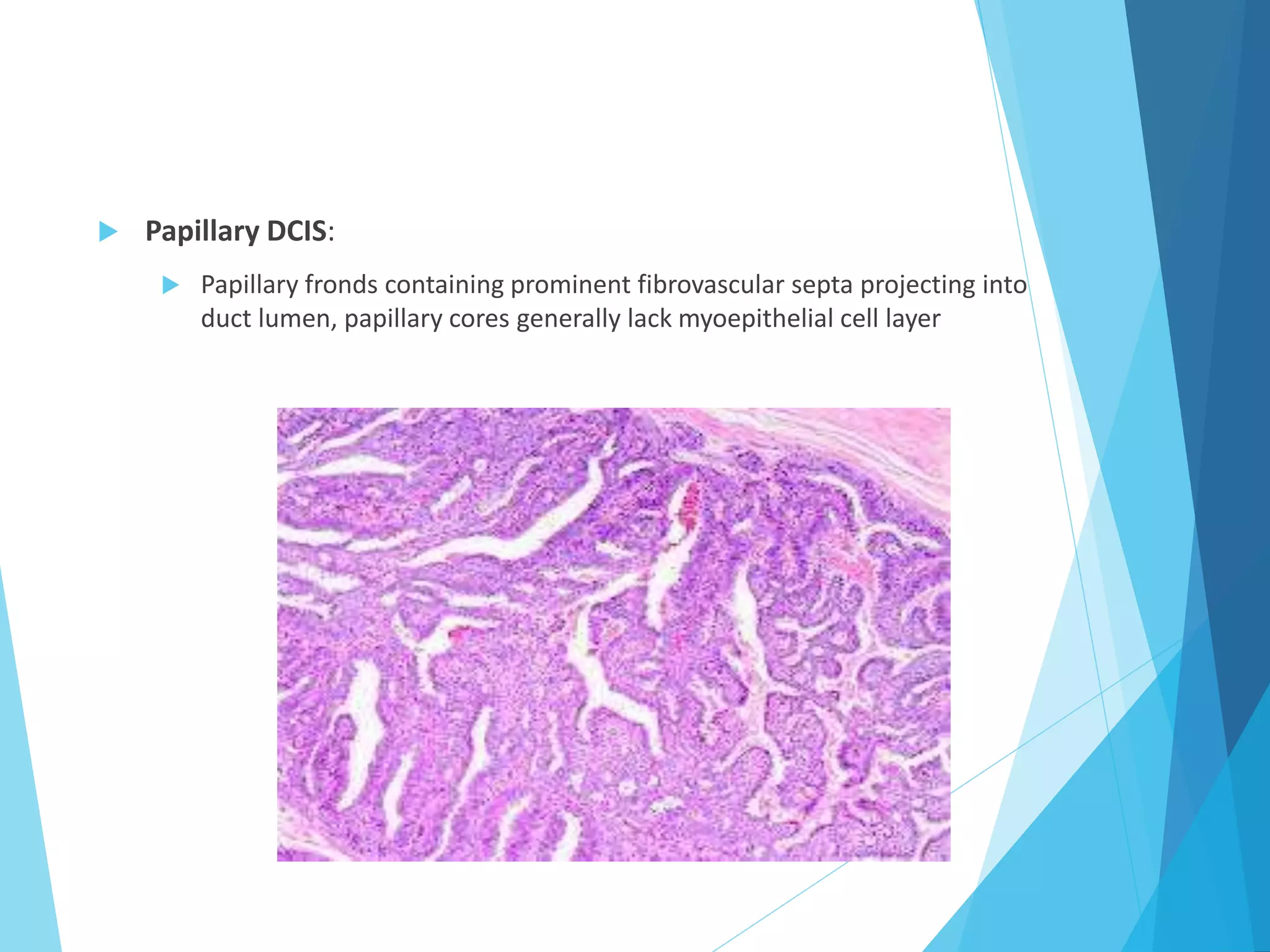 Histopathological Interpretation of Breast Cancer.pptx