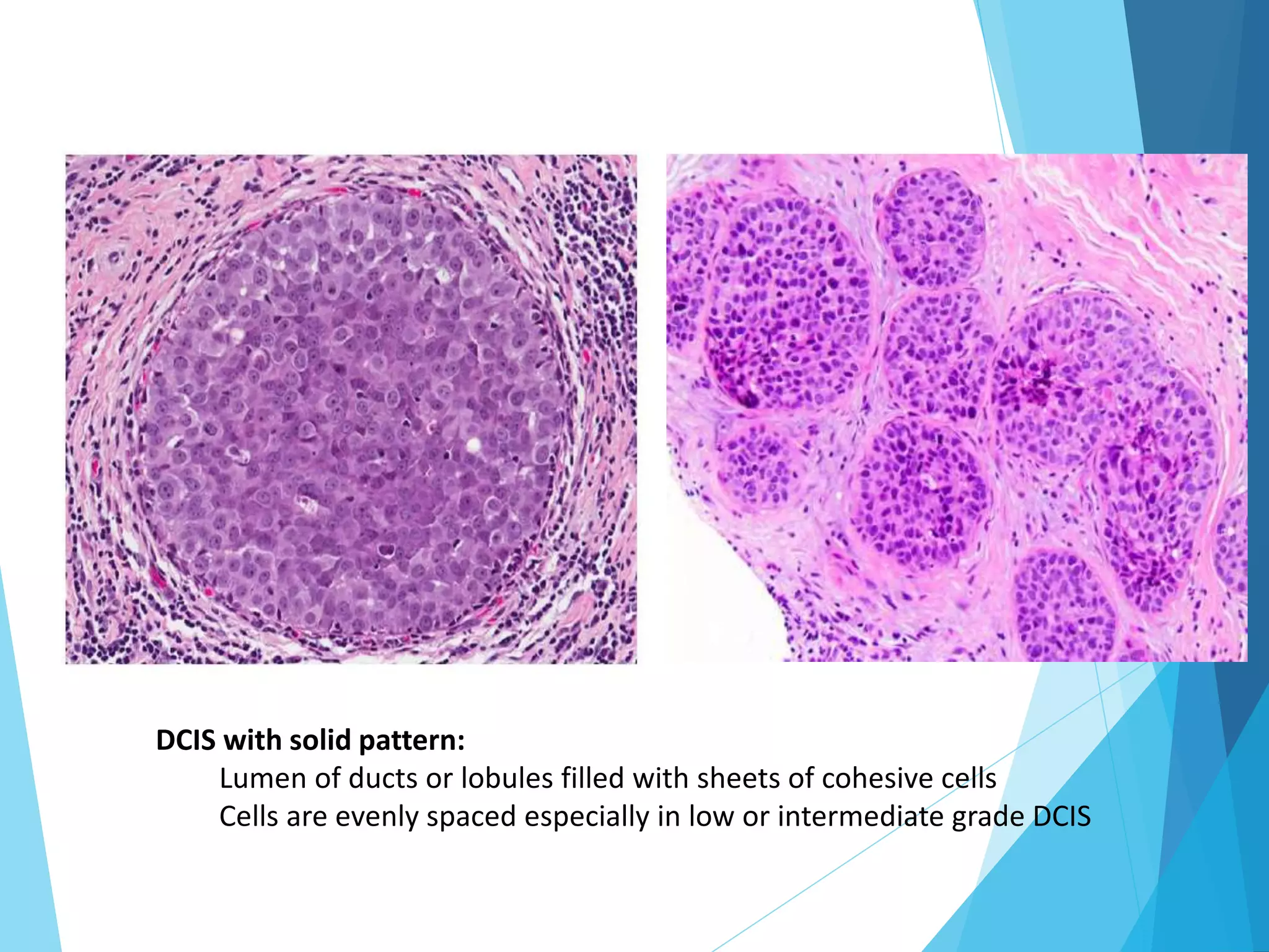 Histopathological Interpretation of Breast Cancer.pptx