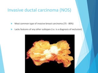 Histopathological Interpretation of Breast Cancer.pptx