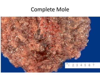 HISTOPATHOLOGICAL SPECIMEN OF OBSTETRICS AND GYNAECOLOGY.pptx