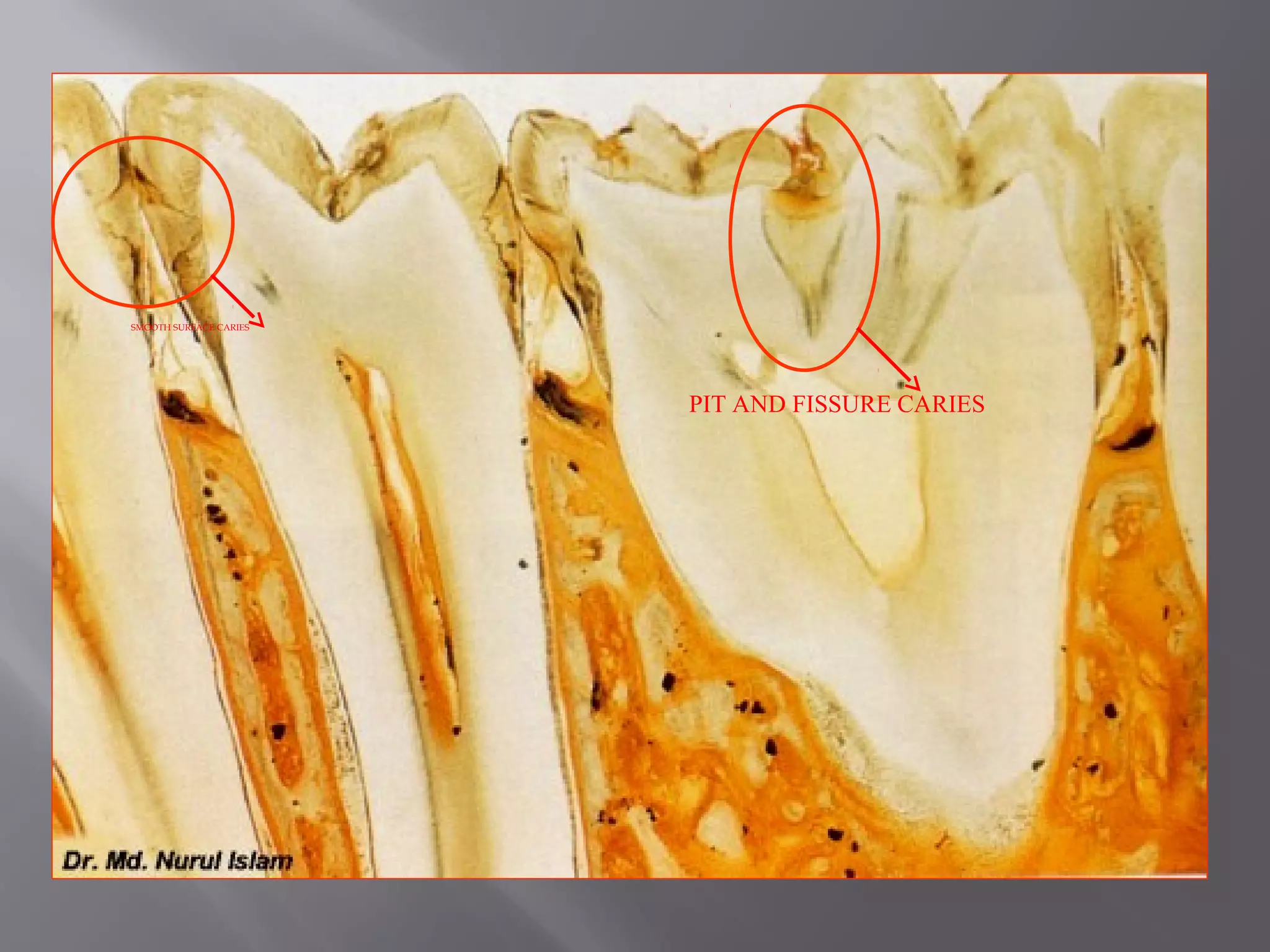 Histopathology & microbiology of dental caries | PPT