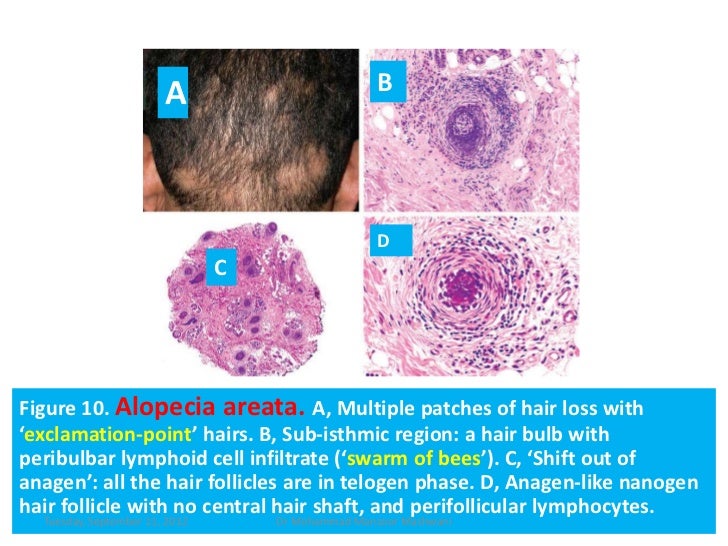 Histopathology of alopecia