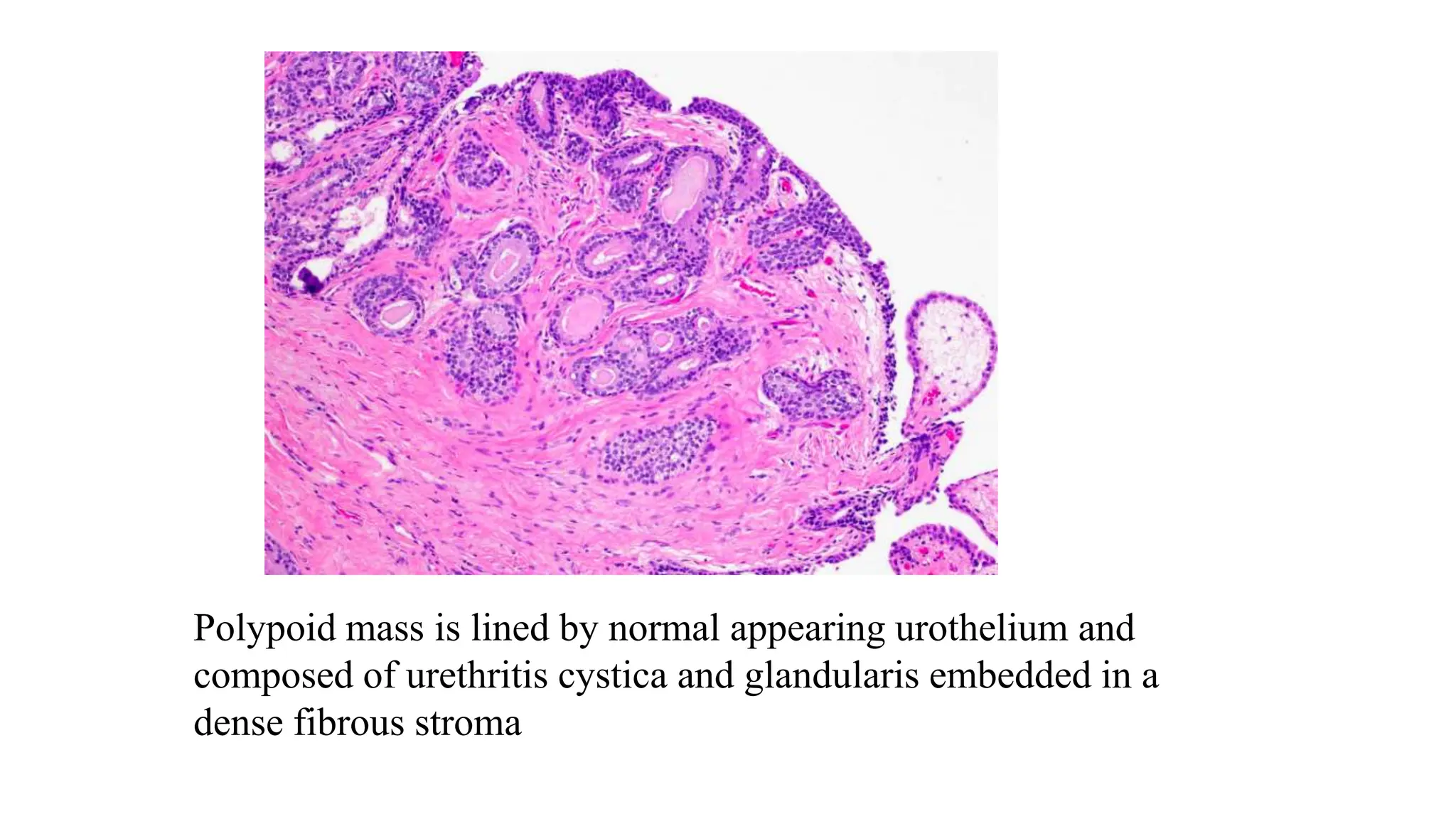 histopathology of bladder and urethra.pptx