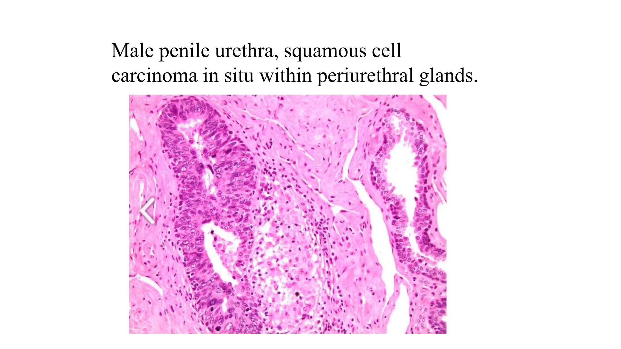 histopathology of bladder and urethra.pptx