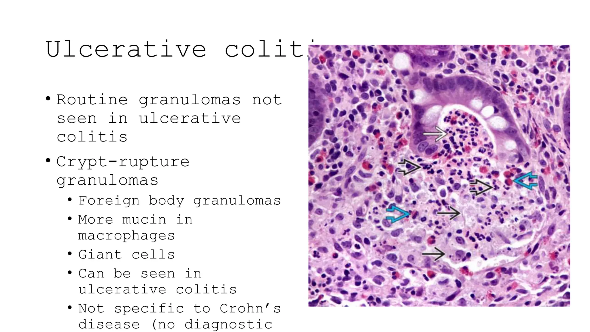 Histopathology of Crohn's disease - Rawa Muhsin | PPTX
