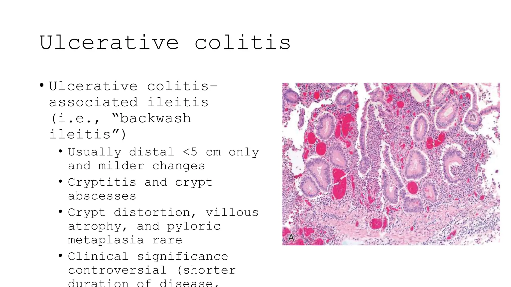 Histopathology of Crohn's disease - Rawa Muhsin | PPTX