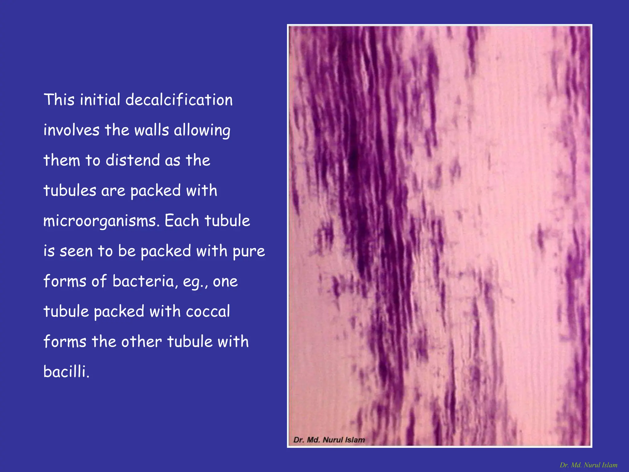 Histopathology_of_dental_Dental_caries_1_compressed.pdf