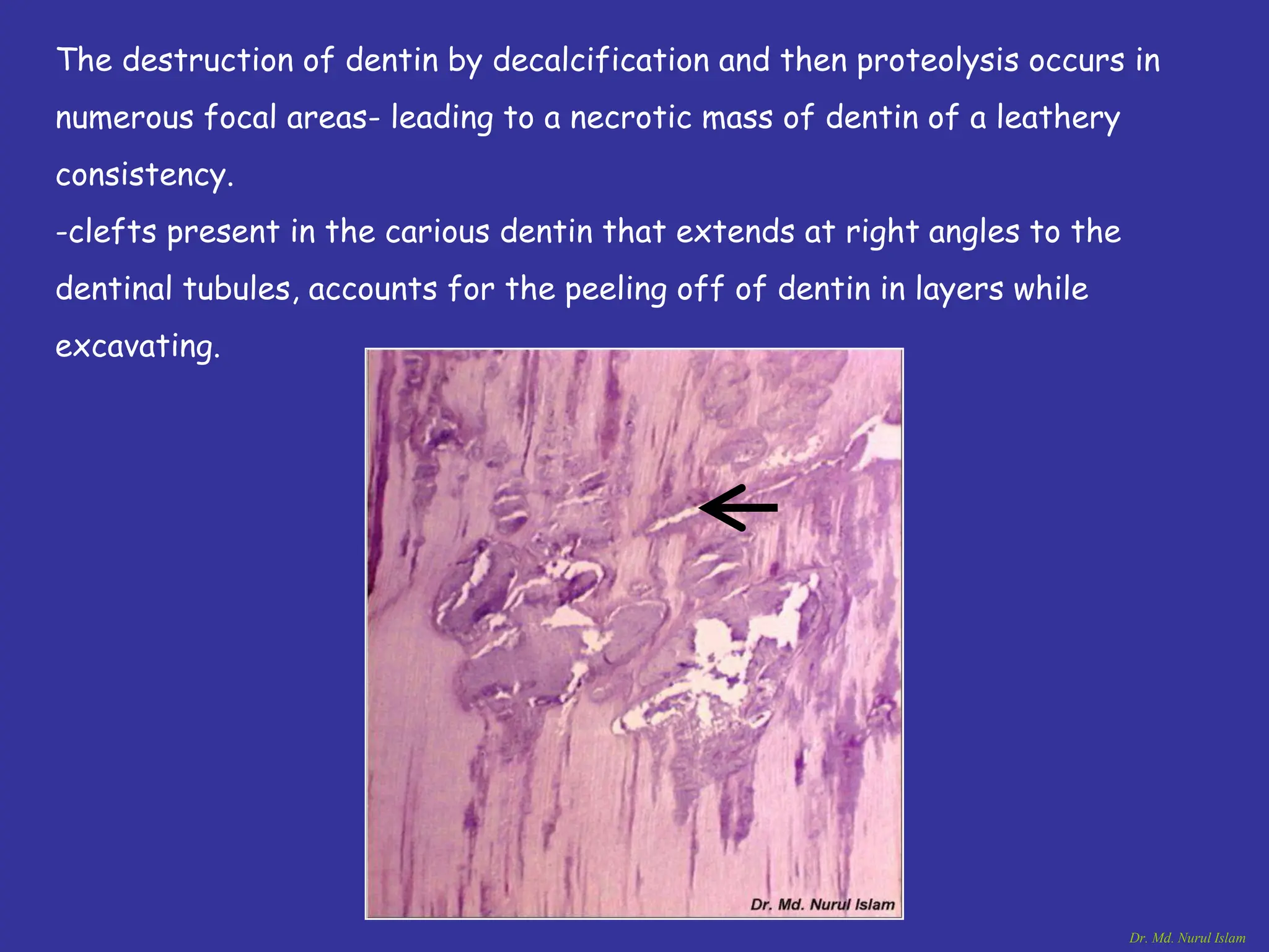 Histopathology_of_dental_Dental_caries_1_compressed.pdf