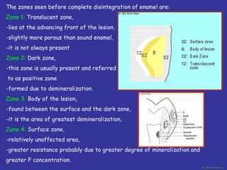 Histopathology_of_dental_Dental_caries_1_compressed.pdf