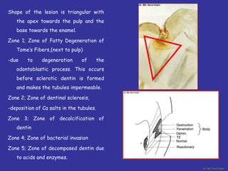 Histopathology_of_dental_Dental_caries_1_compressed.pdf
