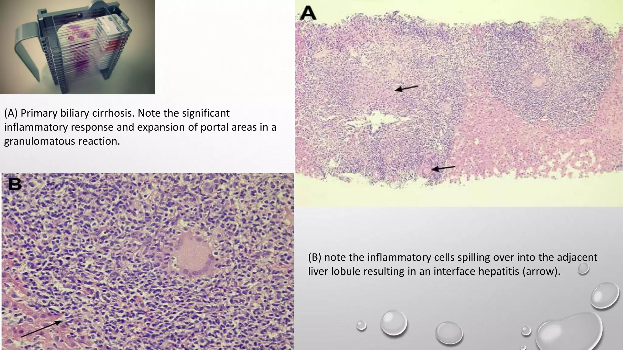 Histopathology of granulomatous liver disease | PDF