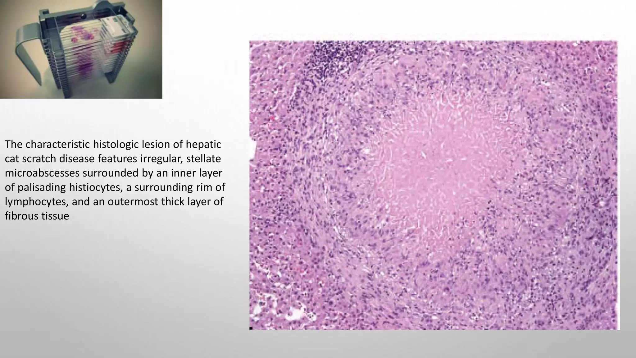 Histopathology of granulomatous liver disease | PDF
