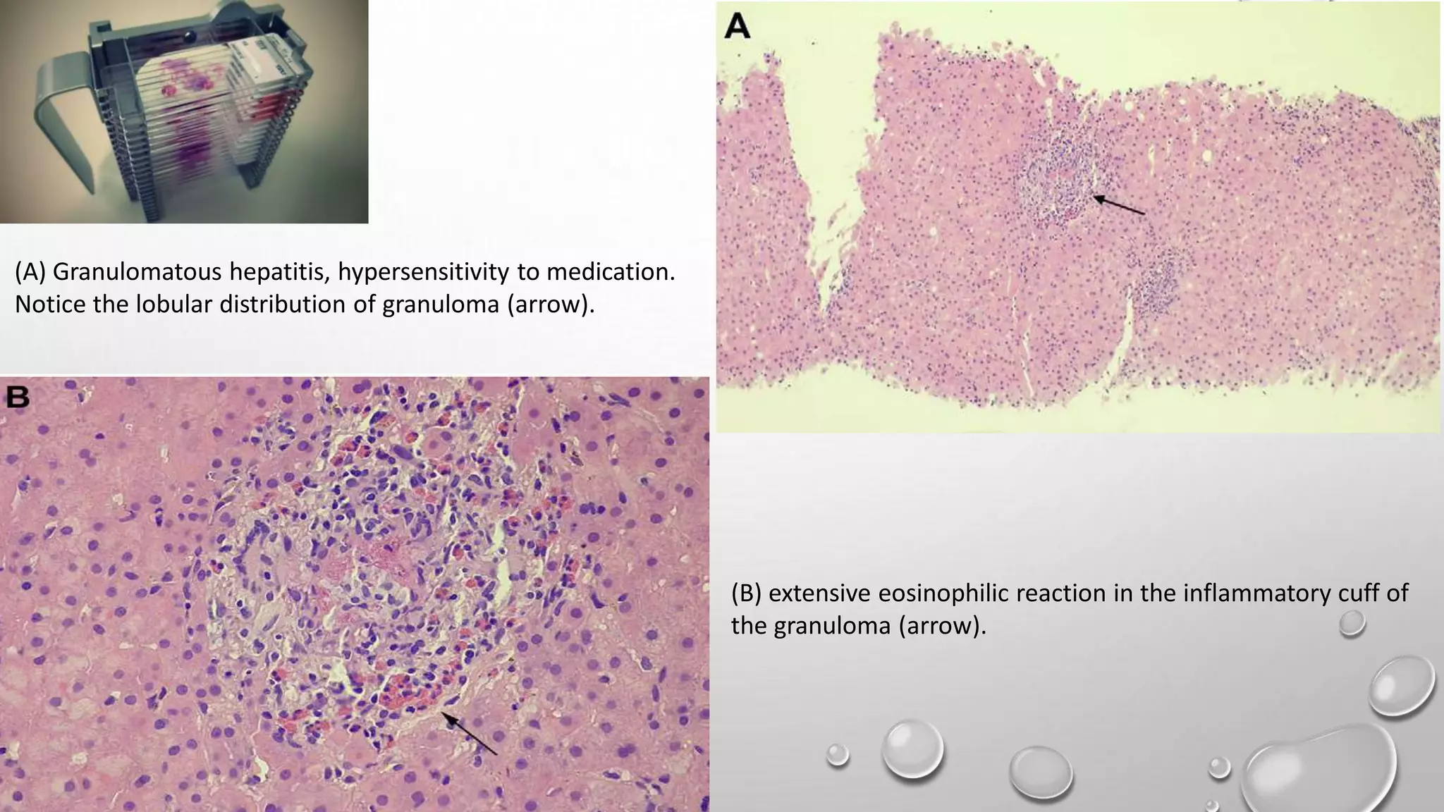 Histopathology of granulomatous liver disease | PDF