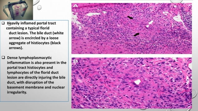 Histopathology of granulomatous liver disease | PDF | Digestive ...