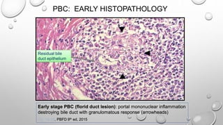 Histopathology of granulomatous liver disease | PDF