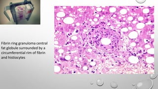 Histopathology of granulomatous liver disease | PDF