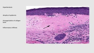 histopathology of lichen et atrophicus dermatology | PPTX