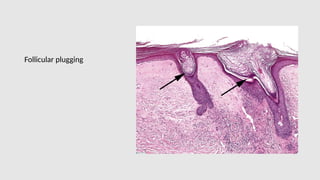 histopathology of lichen et atrophicus dermatology | PPTX