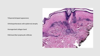 histopathology of lichen et atrophicus dermatology | PPTX