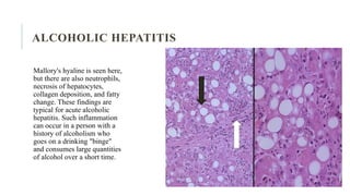 Histopathology of liver.pptxhfhgfhhfhggg | PPT