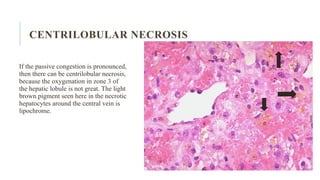 Histopathology of liver.pptxhfhgfhhfhggg | PPT