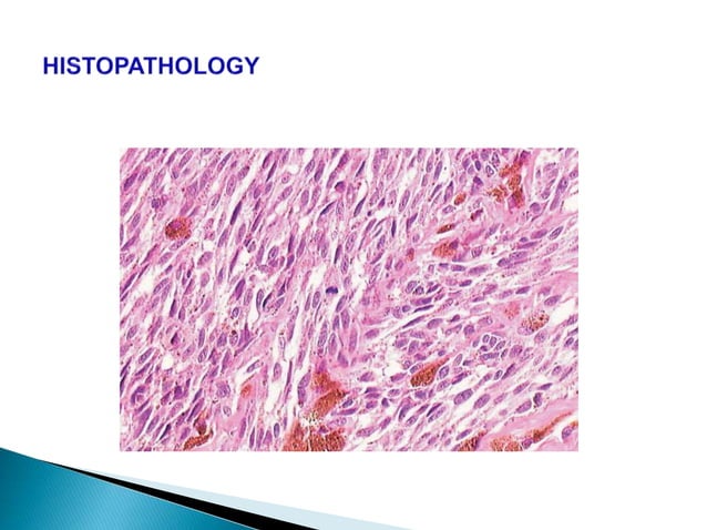 Histopathology Of Malignant Melanoma Pptx