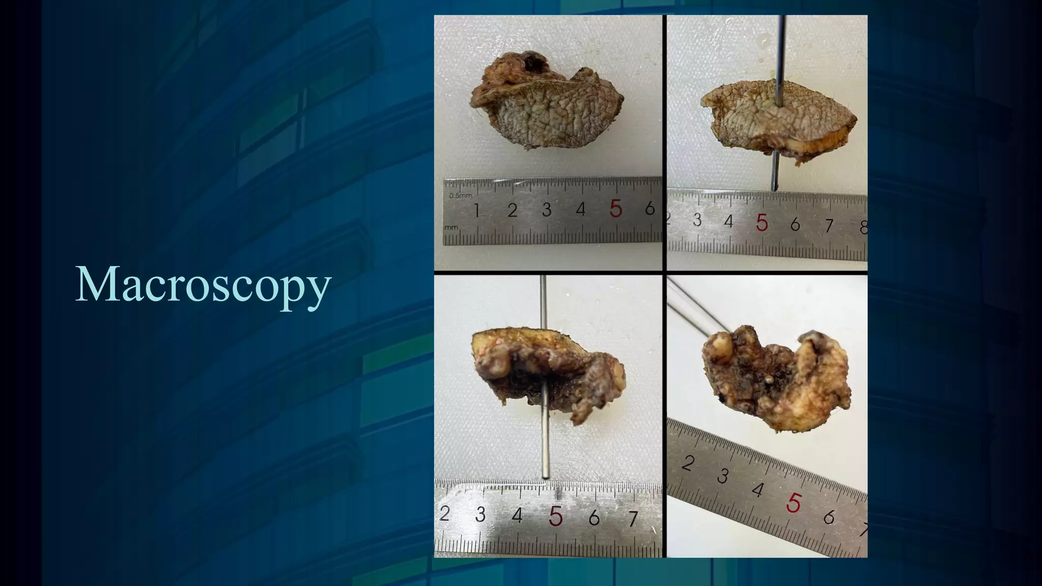 Histopathology of Pilonidal Sinus | PPTX