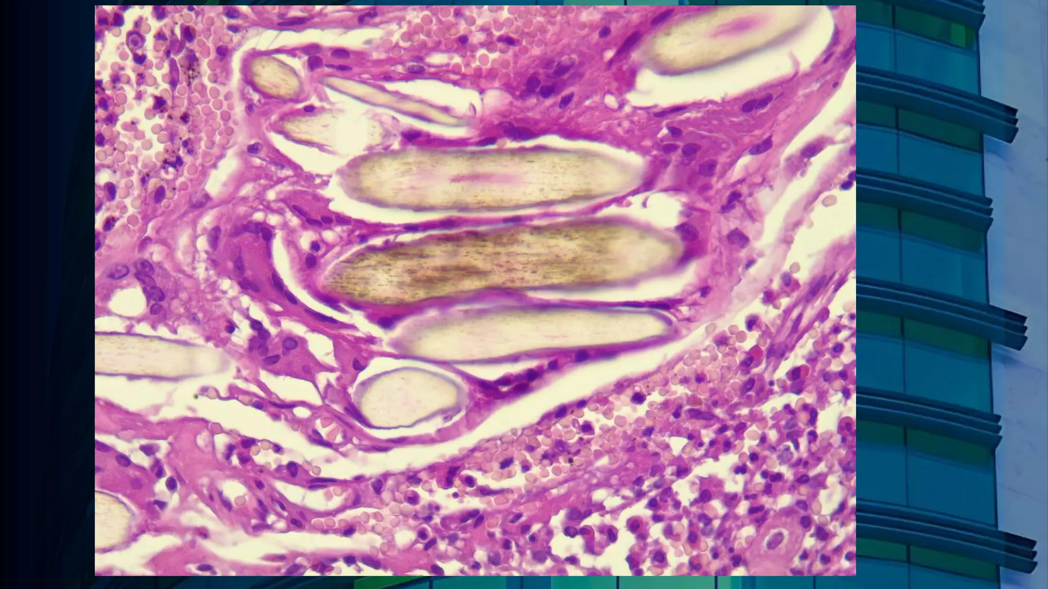 Histopathology of Pilonidal Sinus | PPTX
