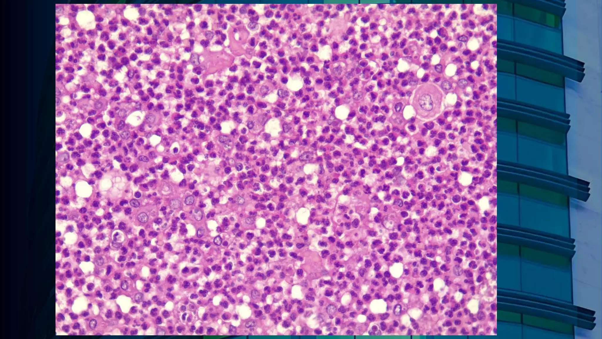 Histopathology of Pilonidal Sinus | PPTX