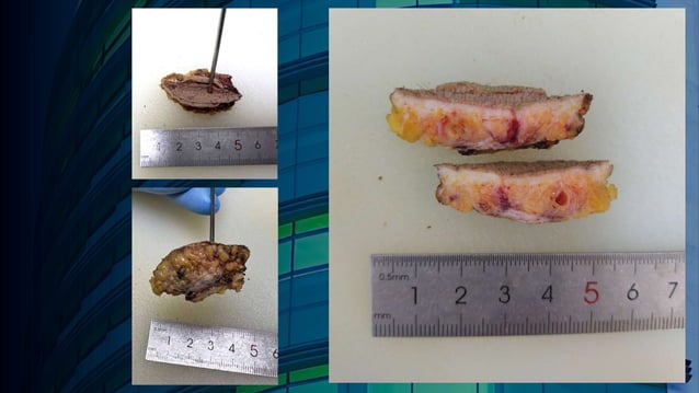 Histopathology of Pilonidal Sinus | PPTX | Ear, Nose and Throat ...