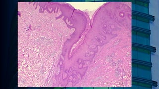 Histopathology of Pilonidal Sinus | PPTX